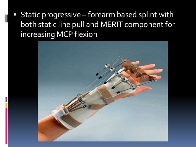 What is a serial static splint - jolopic
