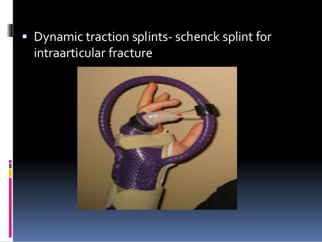 What is a serial static splint - dadneed