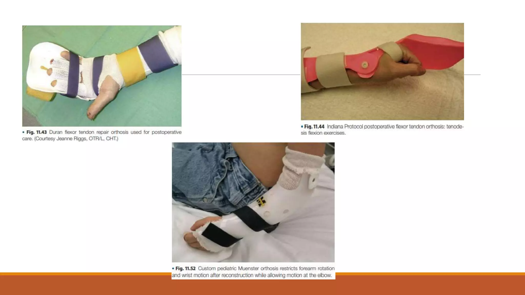Upper Limb orthotic devices.pptx