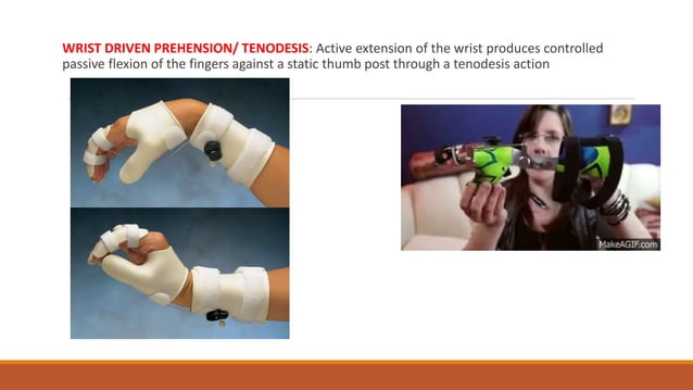 Upper Limb orthotic devices.pptx