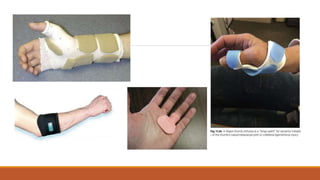 Upper Limb orthotic devices.pptx