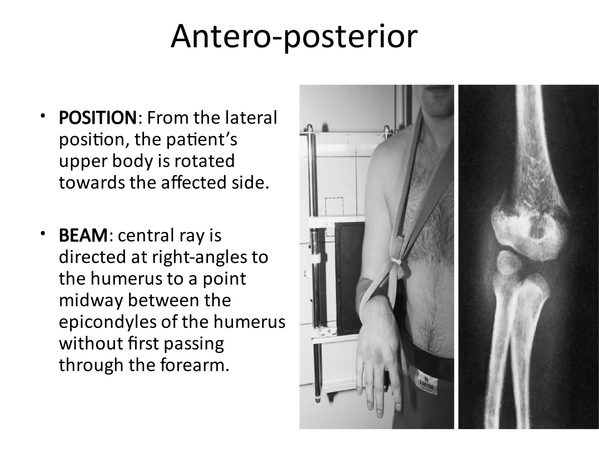 Upper Limb Plain Radiology: DR. MITESH J. PATEL(M.S ORTHO) | PPT | Free ...