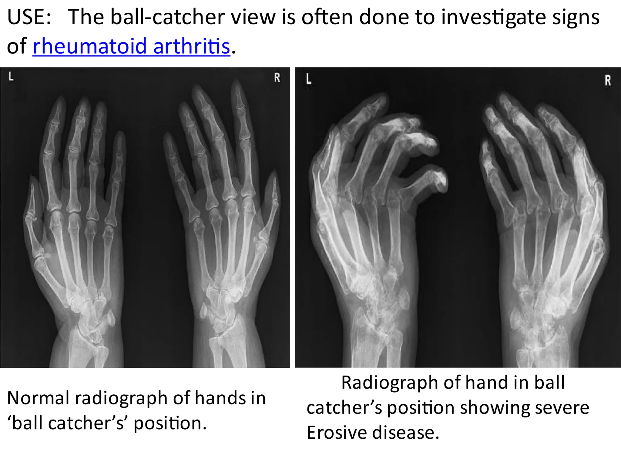 Upper Limb Plain Radiology: DR. MITESH J. PATEL(M.S ORTHO) | PDF