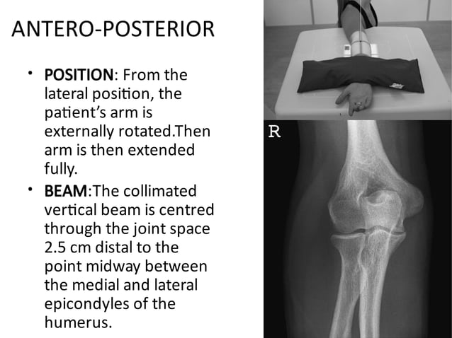 Upper Limb Plain Radiology: DR. MITESH J. PATEL(M.S ORTHO) | PPT | Free ...