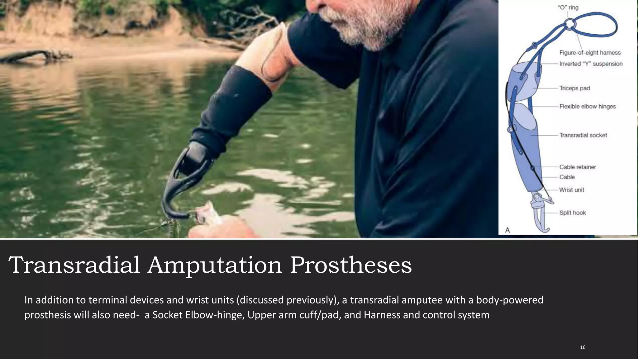 Upper limb prostheses | PPTX