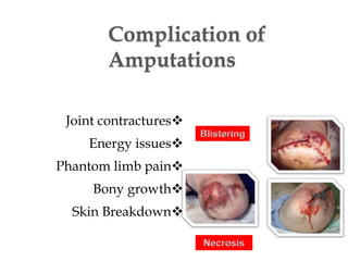 Upper limb prosthetics | PPT