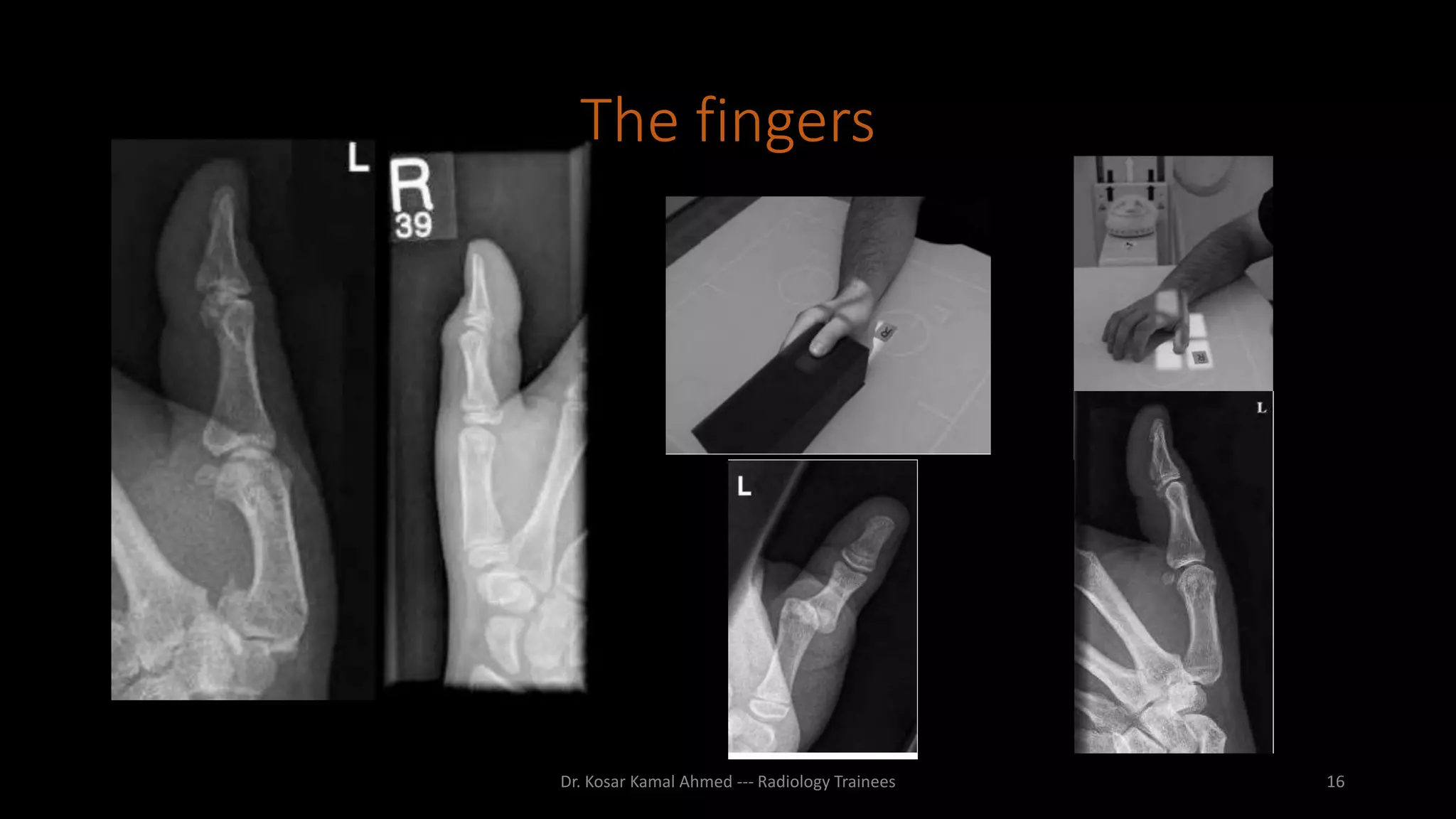 Upper limb radiography | PPTX