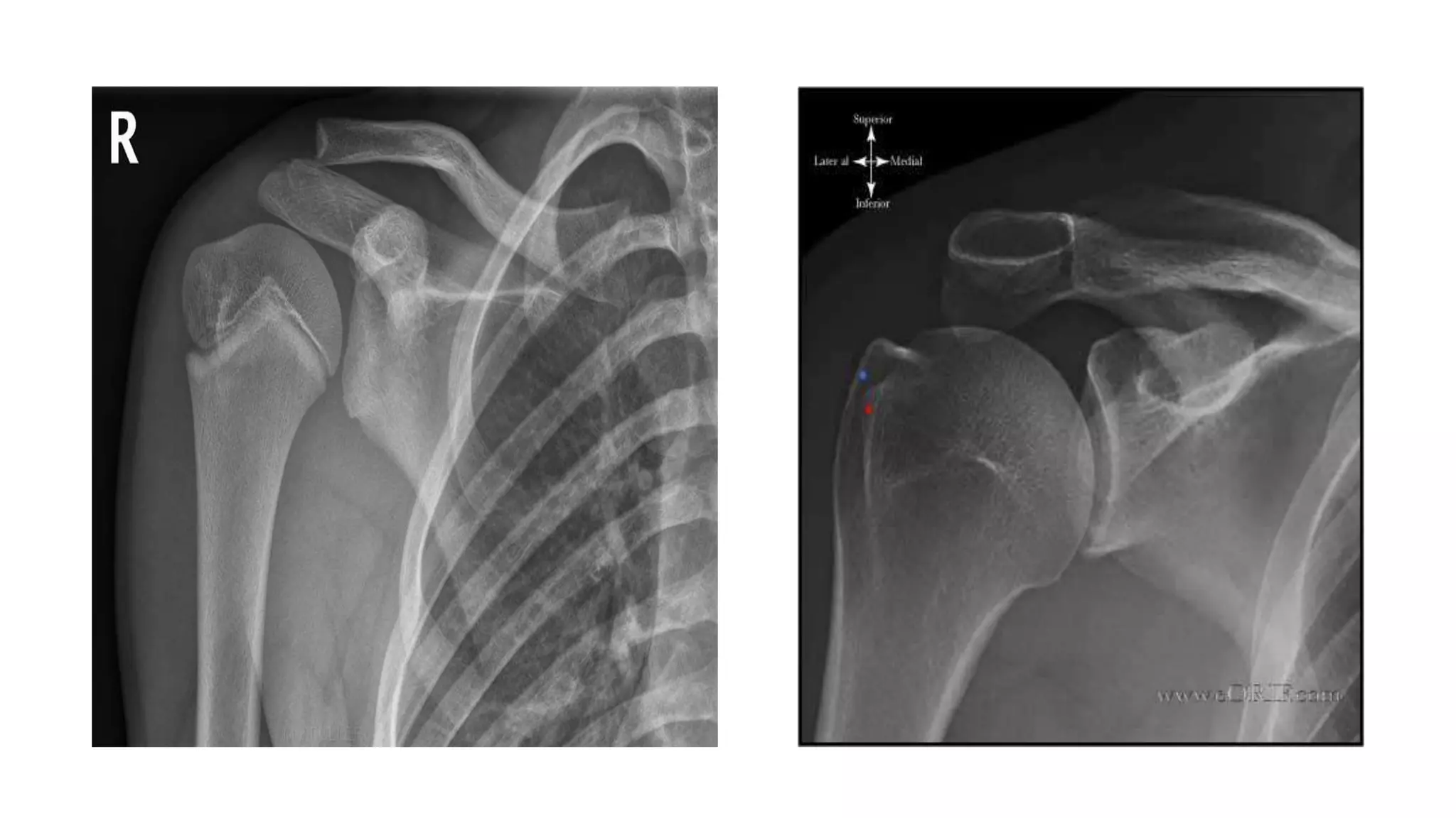 Upper limb radiology | PPTX