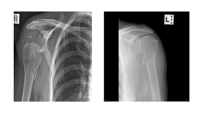 Upper limb radiology | PPTX
