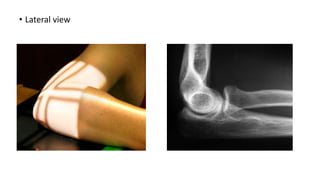 Upper limb radiology | PPTX