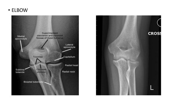 Upper limb radiology