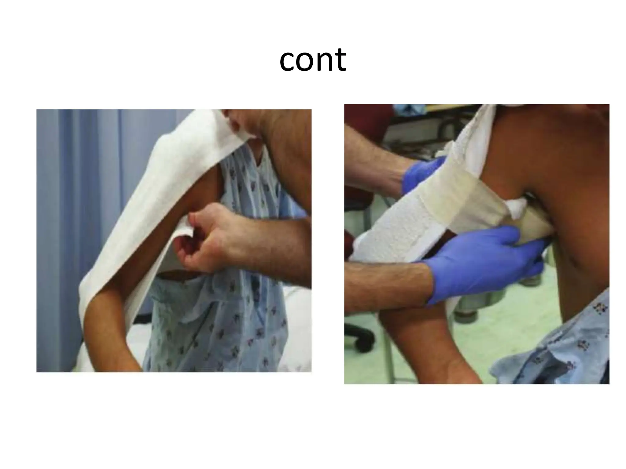 Upper limb slabs, broad arm sling and.pptx