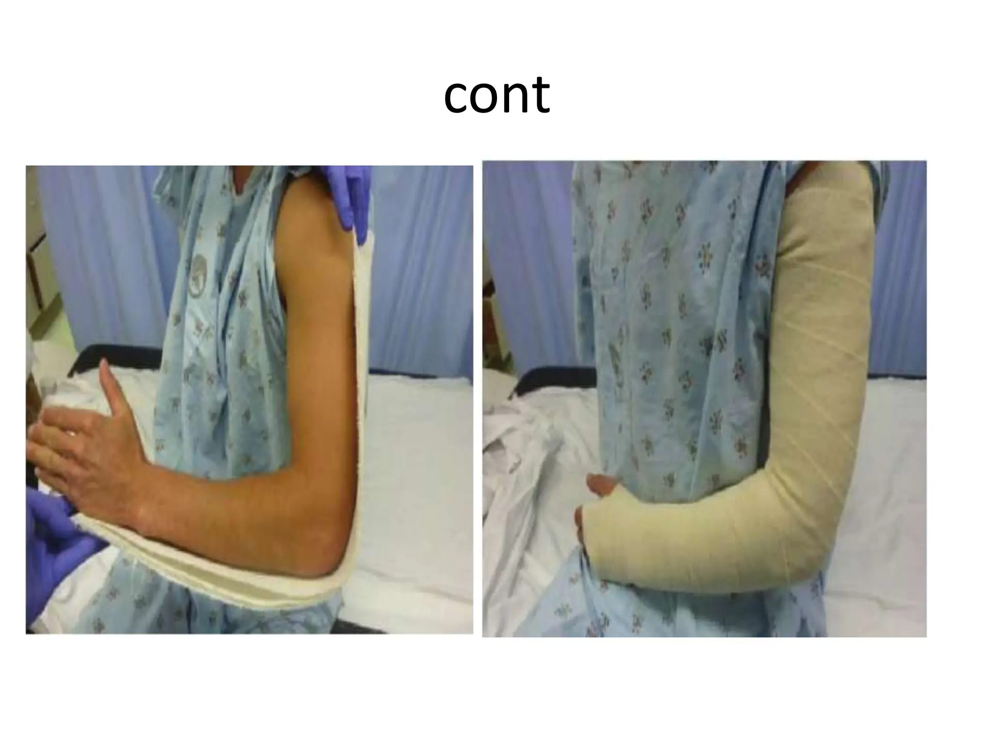 Upper limb slabs, broad arm sling and.pptx