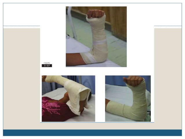 Upper limb slabs, broad arm sling and ayalew - Copy.pptx | First Aid ...