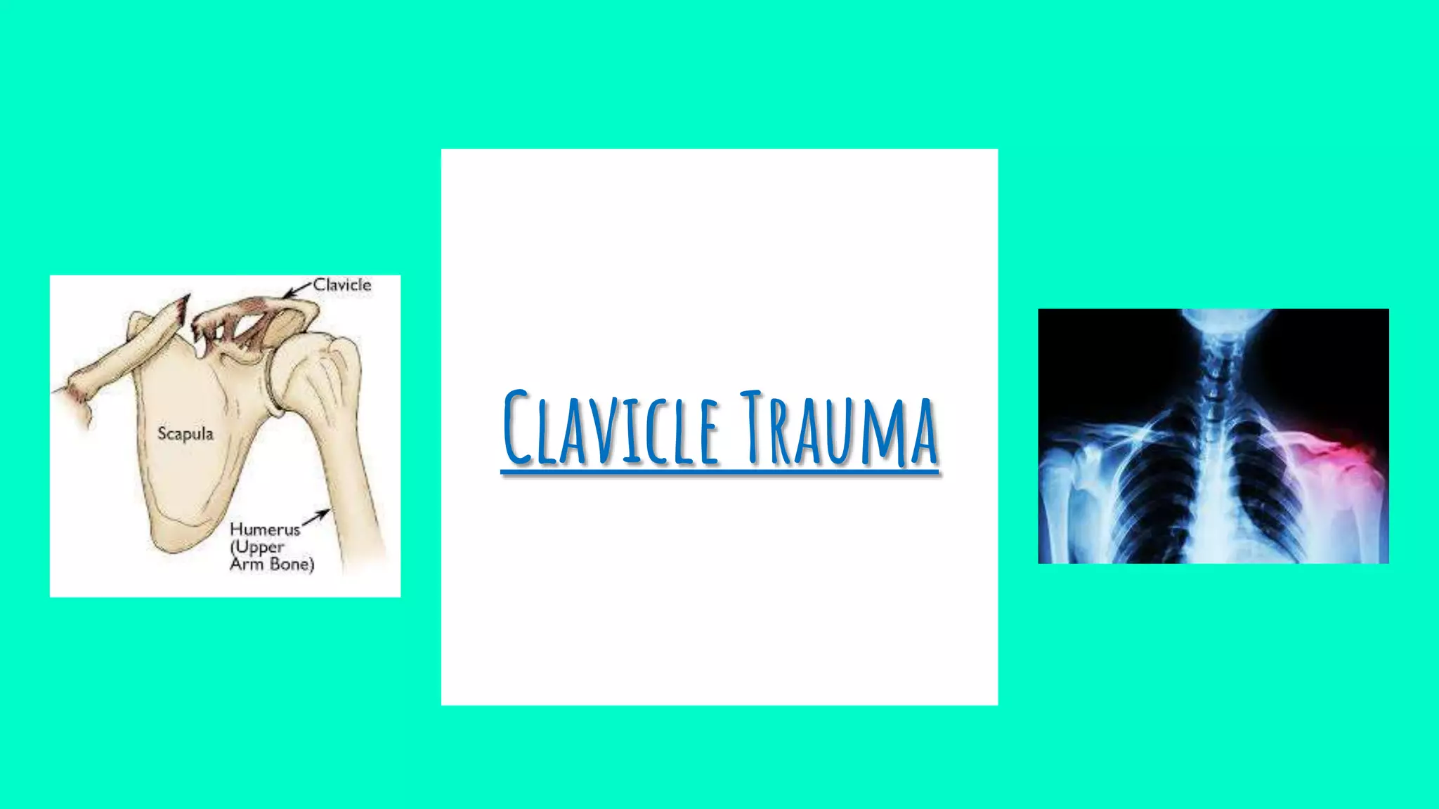 Upper limb trauma ( clavicle & shoulder fracture) | PPT