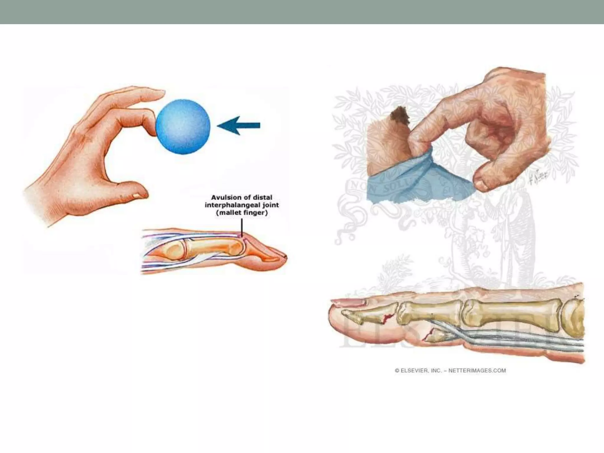 Upper limb trauma part 2 | PPTX