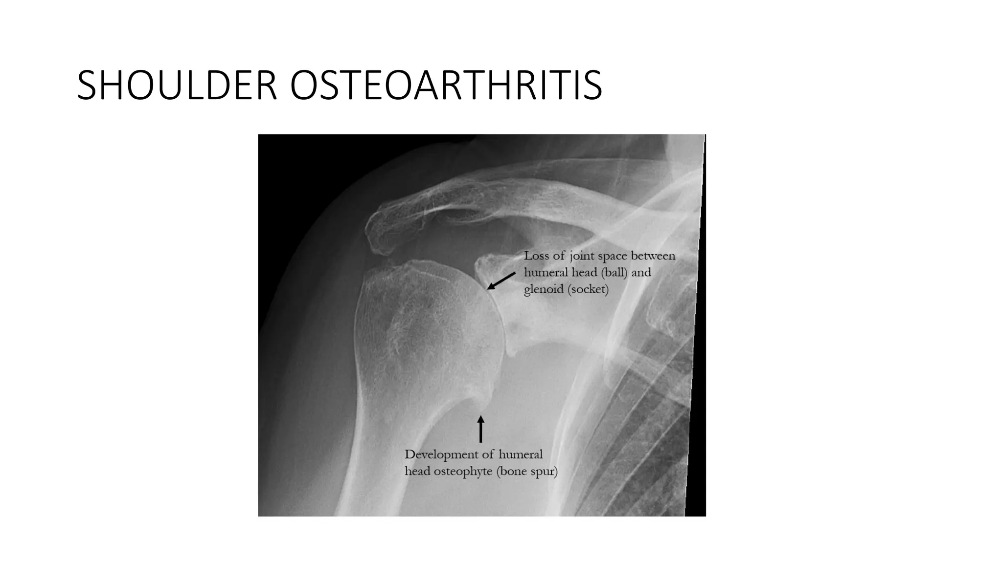 UPPER LIMB XRAY PATHOLOGIES and xray technicques.pptx