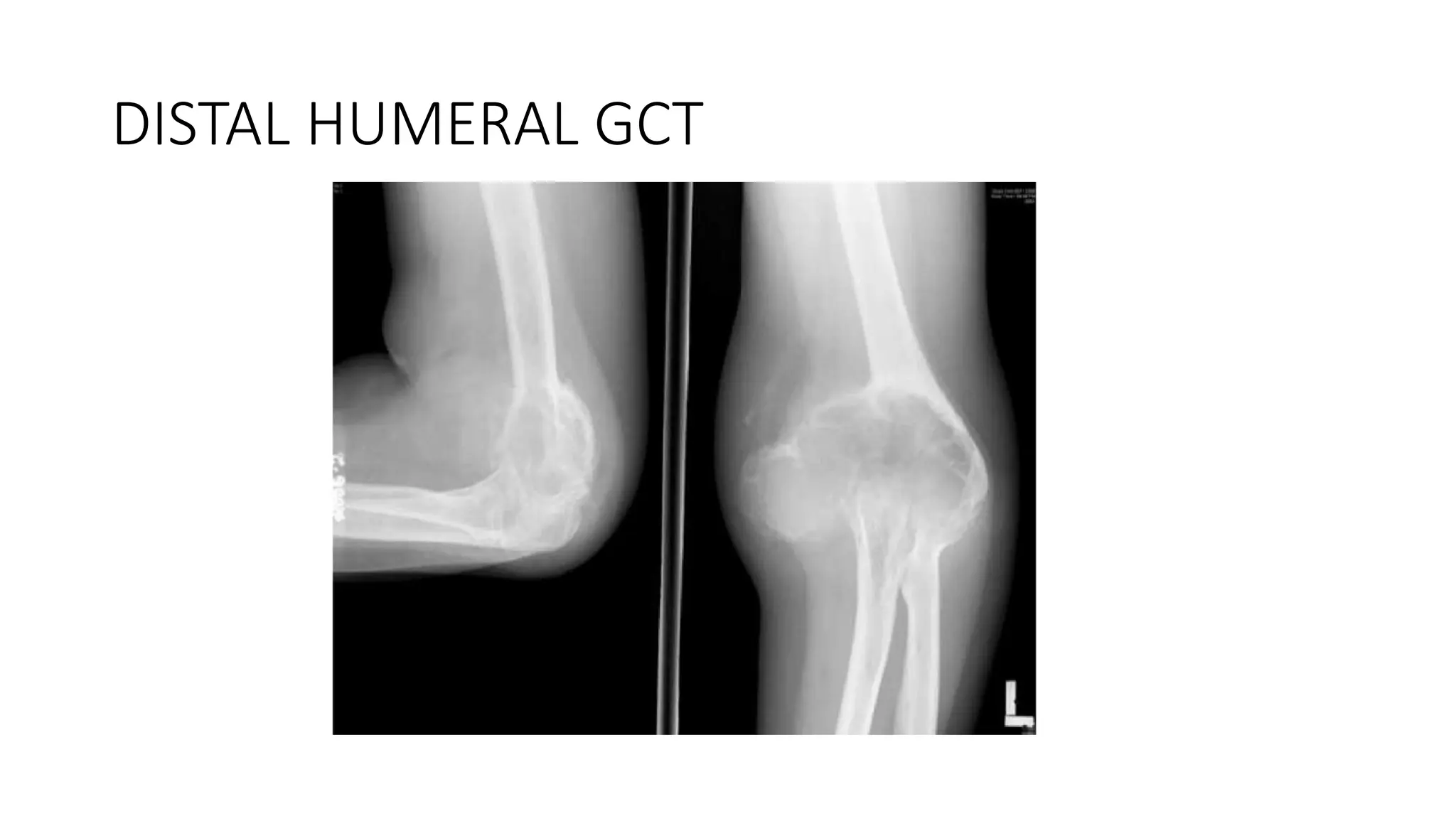 UPPER LIMB XRAY PATHOLOGIES and xray technicques.pptx