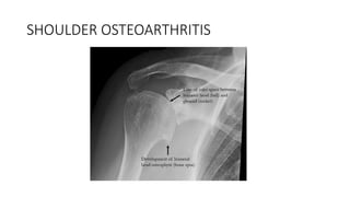 UPPER LIMB XRAY PATHOLOGIES and xray technicques.pptx