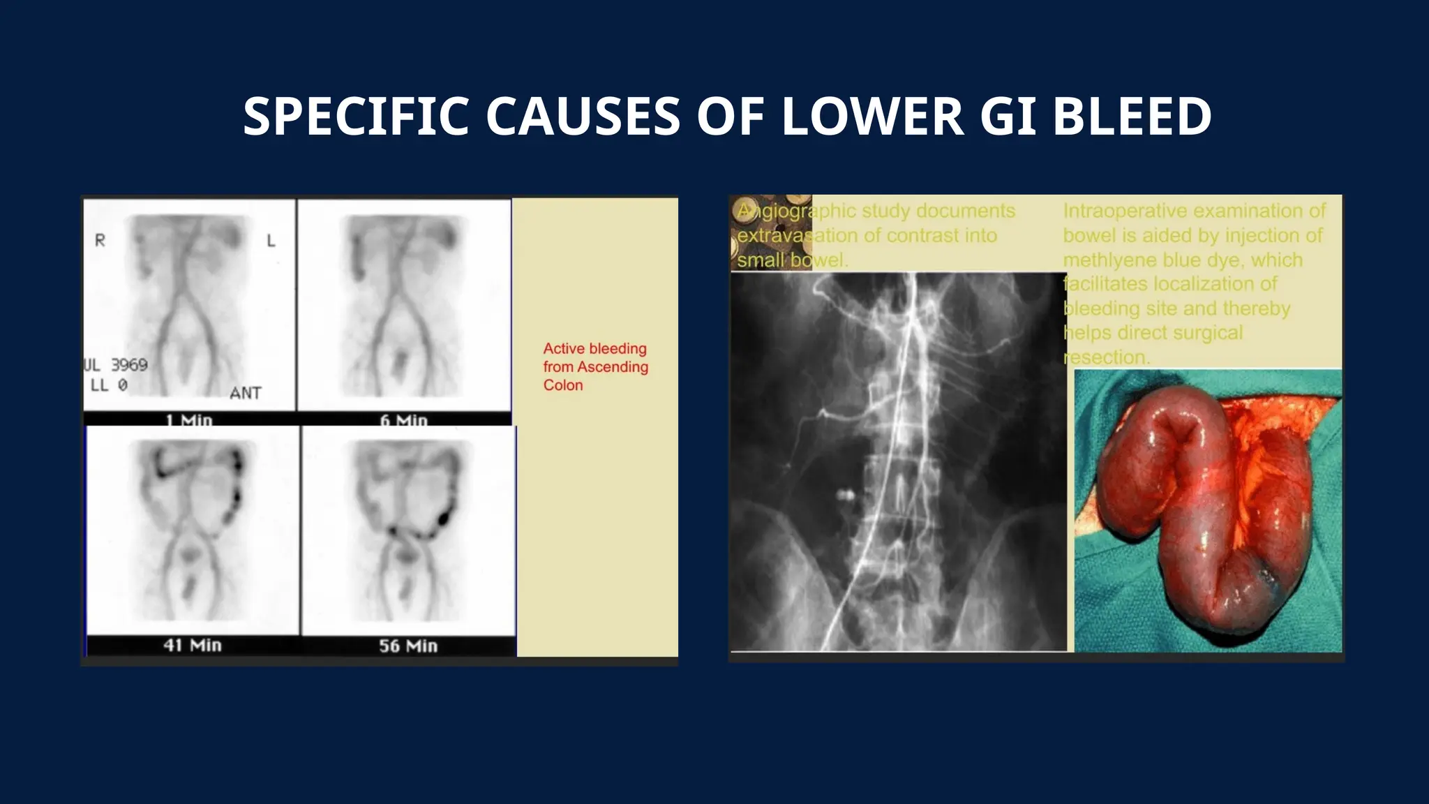 Patient with Upper & Lower GI bleeding .pptx
