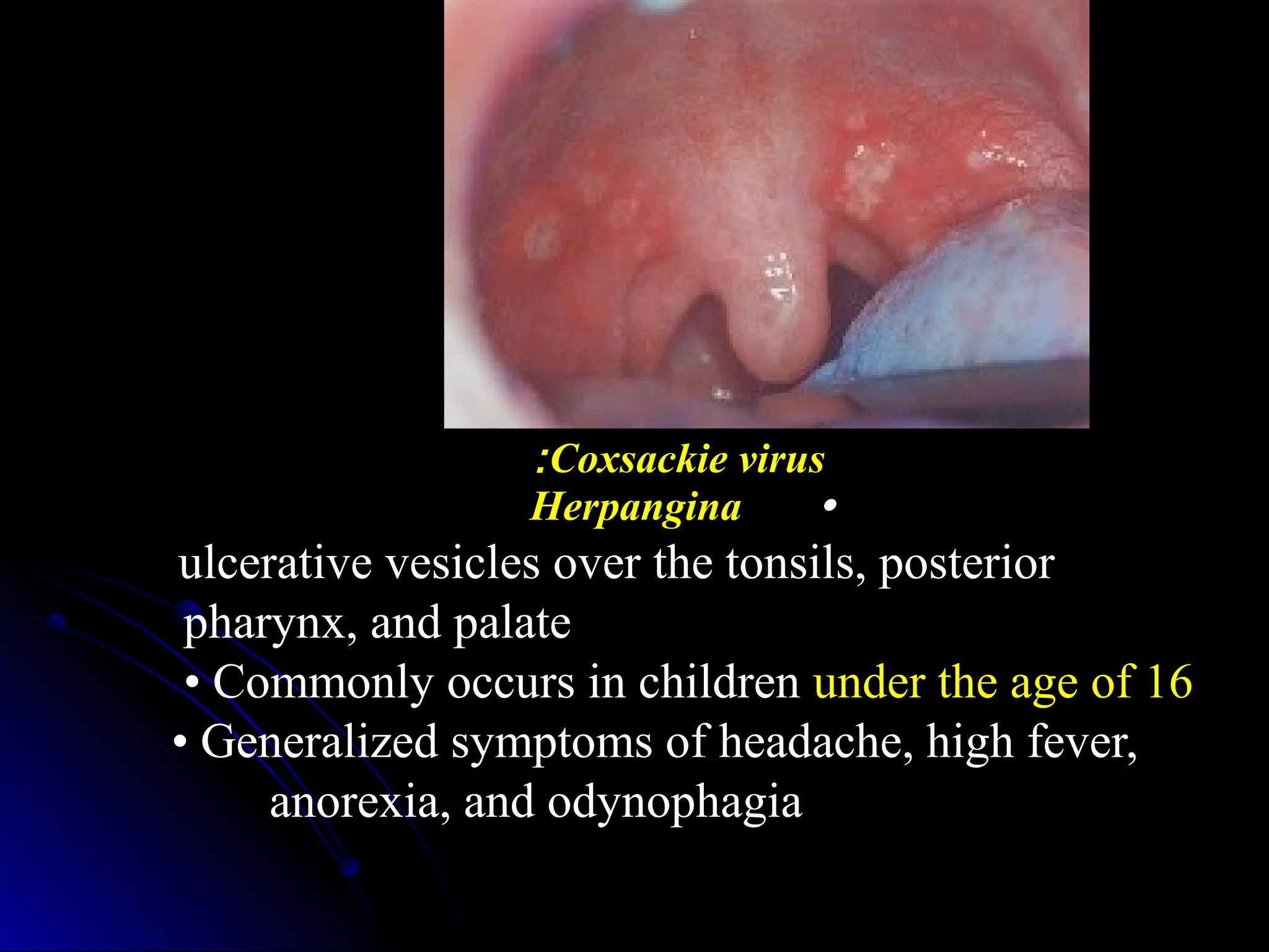 Upper respiratory infections in children | PPT