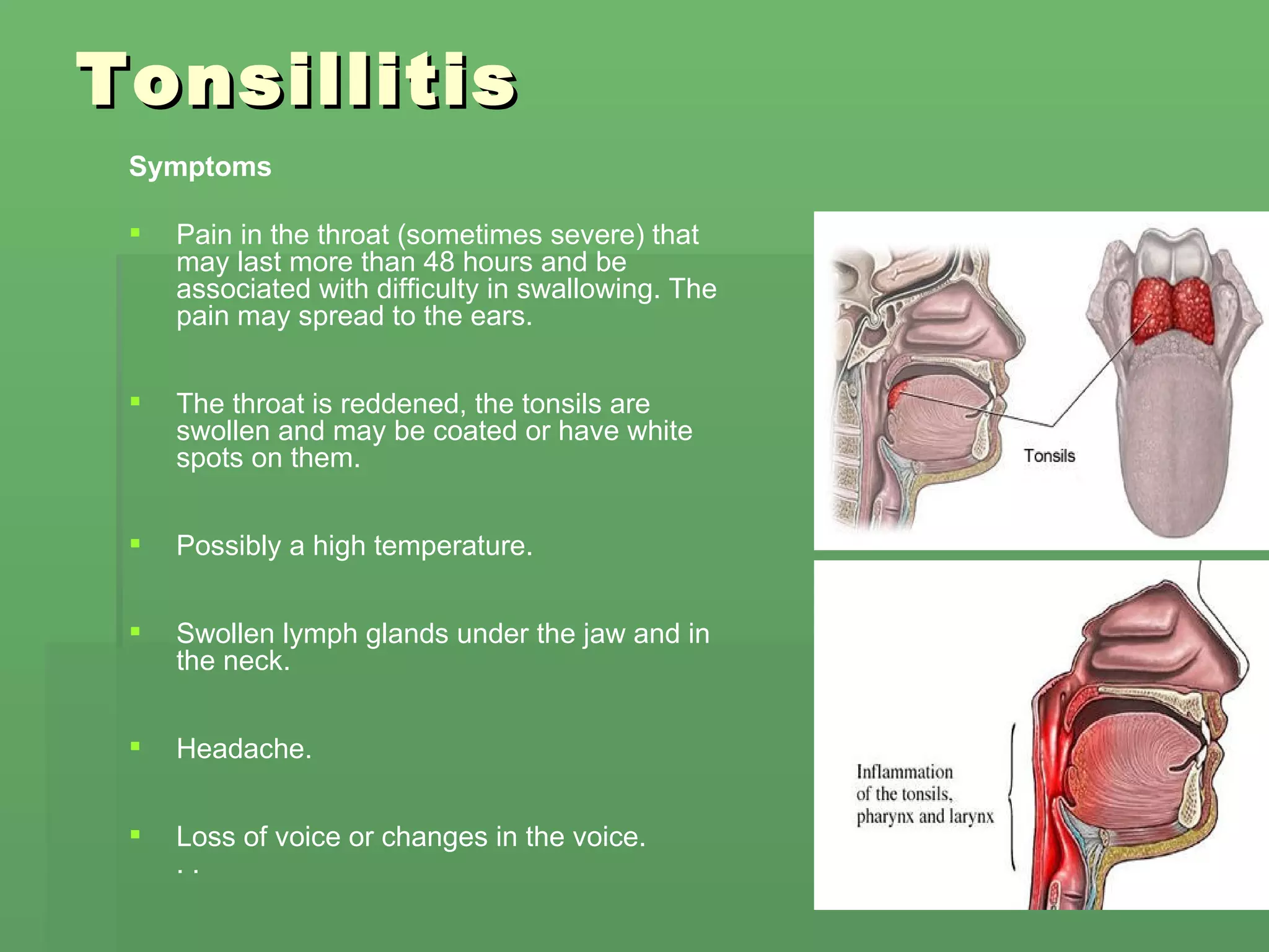 Upper Respiratory Tract Infection | PPT