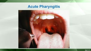 Upper Respiratory Tract Infection by Dr. Sookun Rajeev Kumar | PPTX