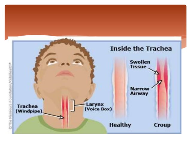 PEDIATRIC: Upper respiratory tract infectionS in children: SINUSITIS ...