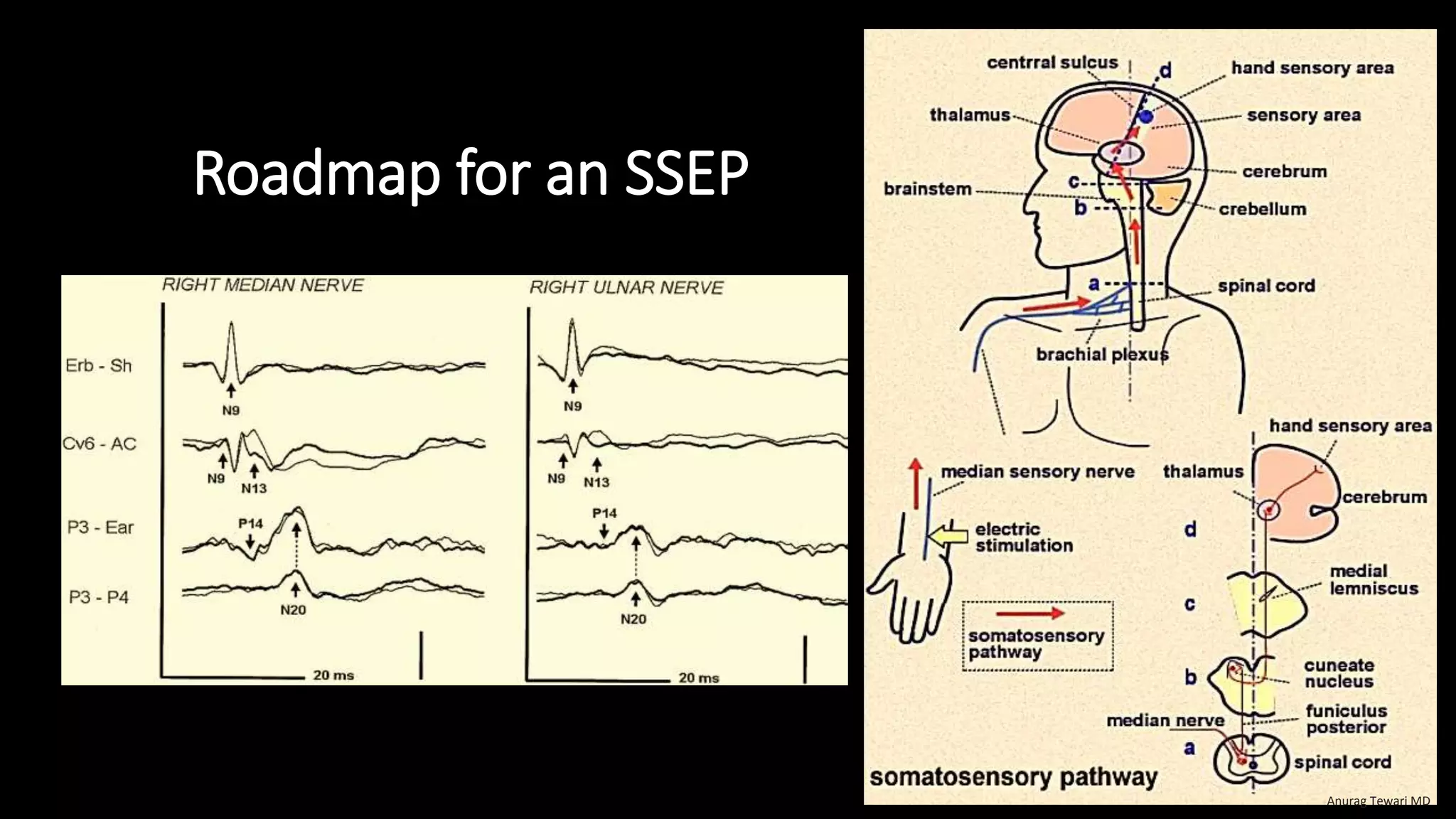 Upper Extremity Somatosensory Evoked Potential (Upper SSEP) | PPTX