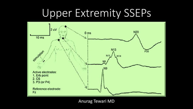 Upper Extremity Somatosensory Evoked Potential (Upper SSEP) | PPTX ...