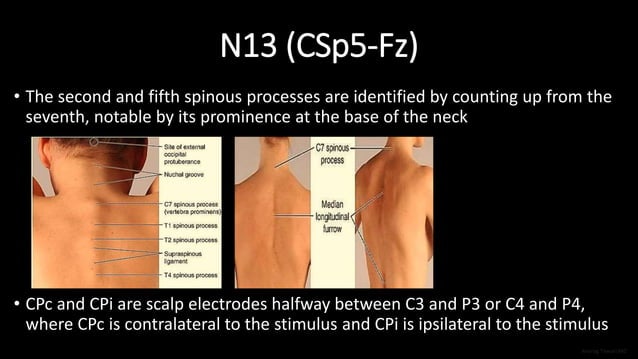 Upper Extremity Somatosensory Evoked Potential (Upper SSEP)