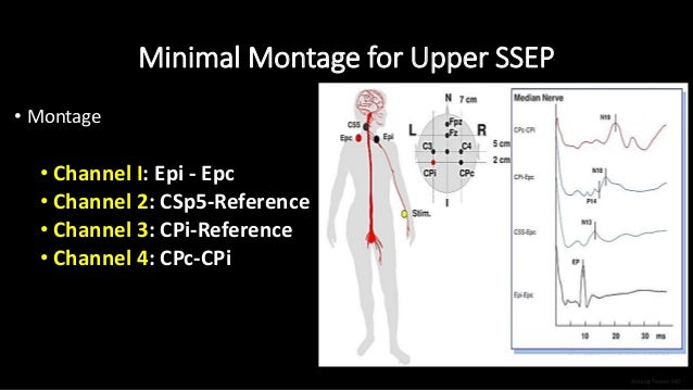 Upper Extremity Somatosensory Evoked Potential (Upper SSEP)