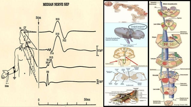 Upper Extremity Somatosensory Evoked Potential (Upper SSEP)