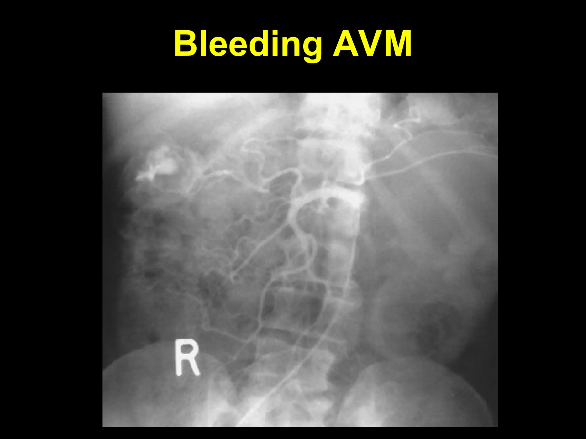 Upper Vs Lower Gi Bleeding Ppt