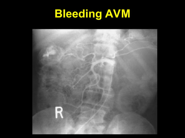 Upper vs lower GI Bleeding ..........ppt