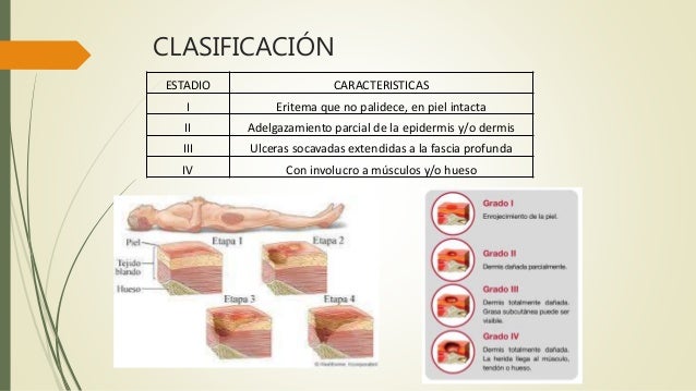 Ulceras Por Presión