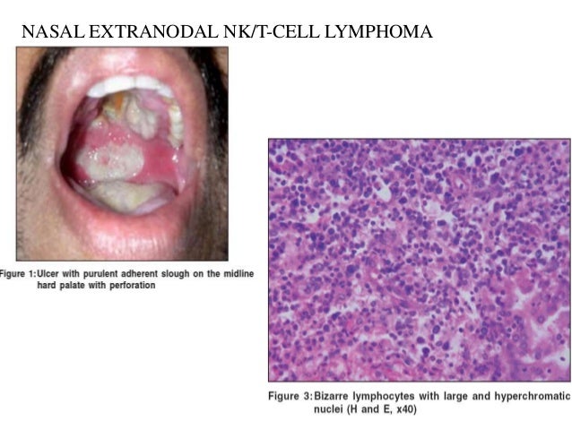 oral lymphoma