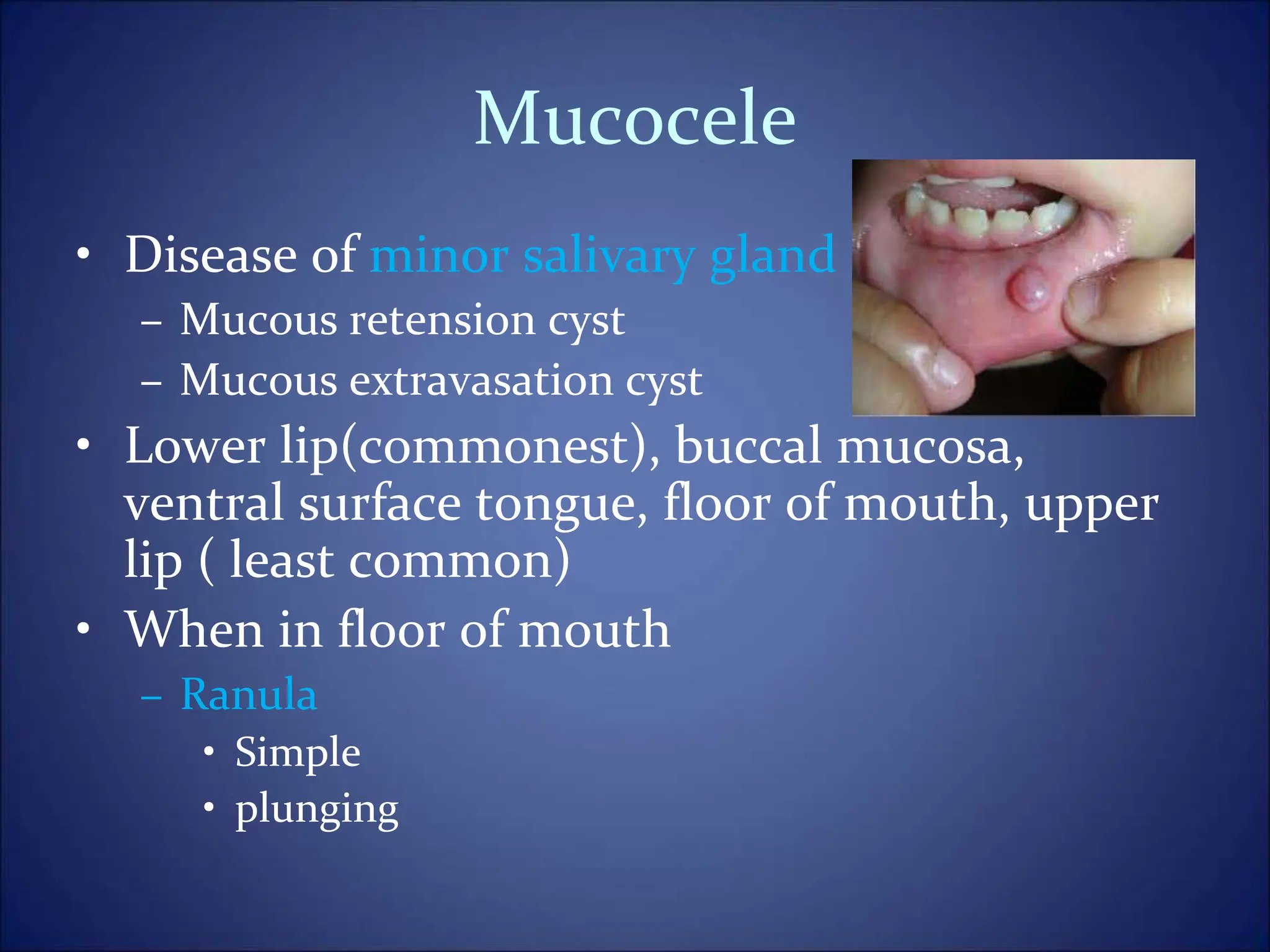 Oral_cavity_ulcers in otolaryngology .ppt