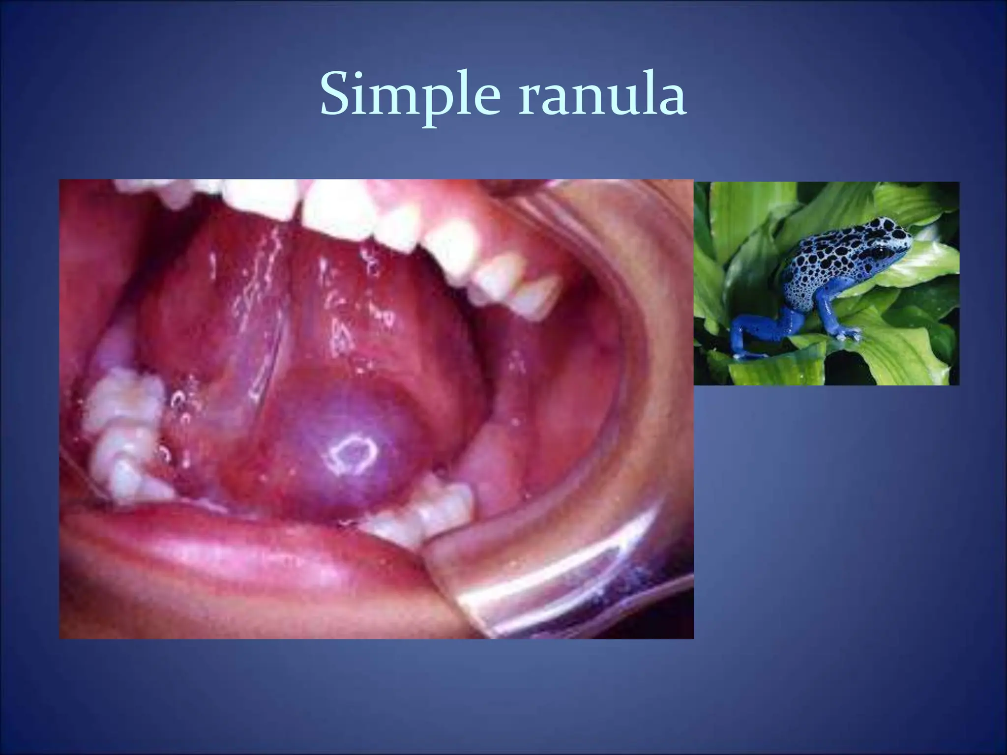 Oral_cavity_ulcers in otolaryngology .ppt