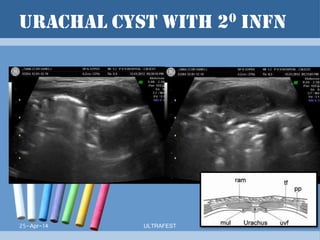 URACHAL MASSES. Dr Saneej | PPTX