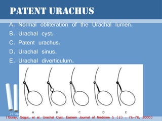 URACHAL MASSES. Dr Saneej | PPTX