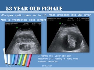URACHAL MASSES. Dr Saneej | PPTX