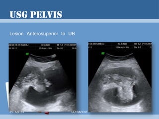 URACHAL MASSES. Dr Saneej | PPTX
