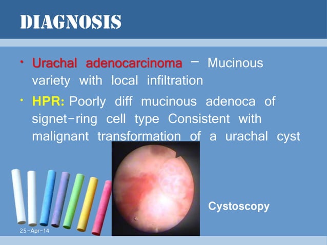 URACHAL MASSES. Dr Saneej | PPTX | Medical Health