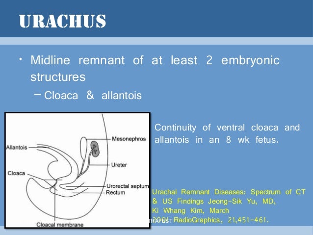 Urachal Masses Dr Saneej