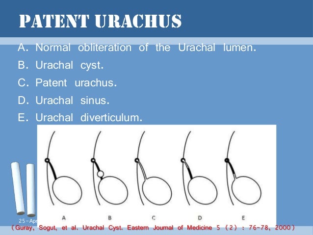 URACHAL MASSES. Dr Saneej