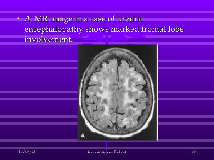 Uremic Encephalopathy