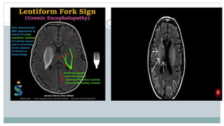 Diagnosis and Managment of Uremic Encephalopathy | PPTX