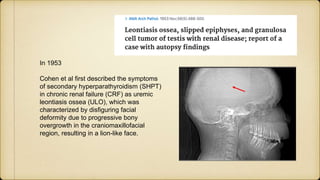 Uremic Leontiaisis Ossea.ppt