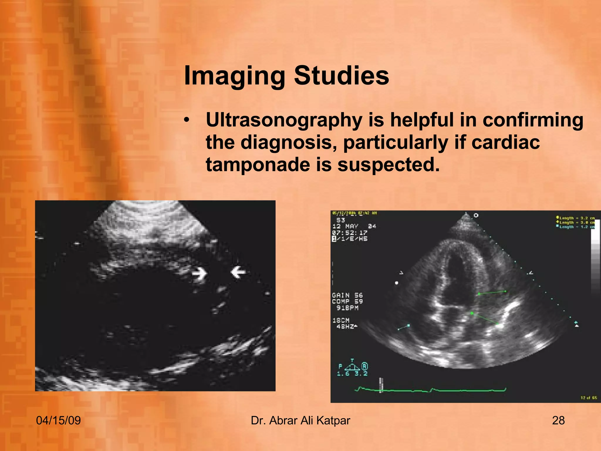 Uremic Pericarditis | PPT
